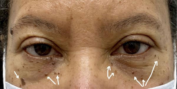 Eyelid Growth/Lesion Removal Plano TX - Legacy Eyelids & Cosmetic Surgery