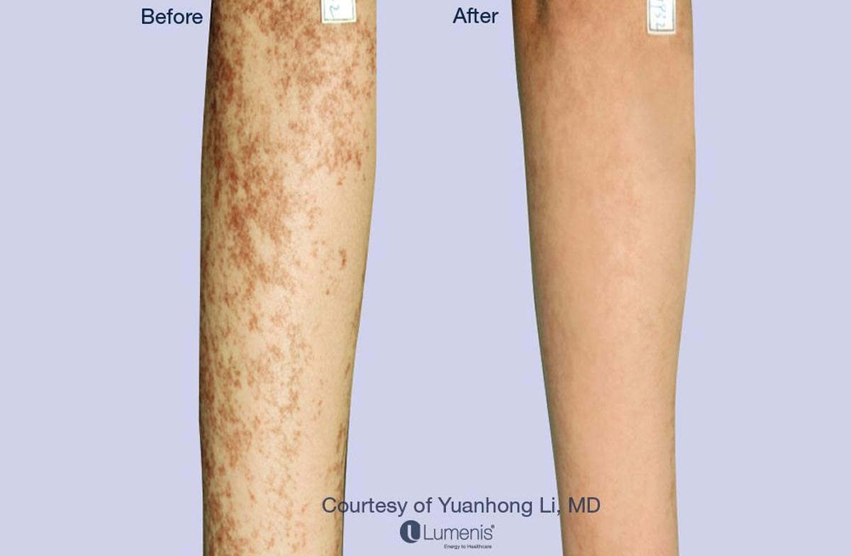 Pigmentation Plano TX Archives - Legacy Eyelids & Cosmetic Surgery